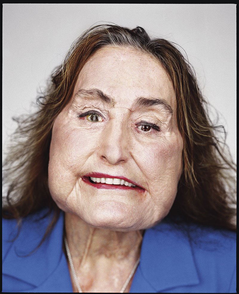 Trasplantes faciales, el significado de tener un rostro nuevo