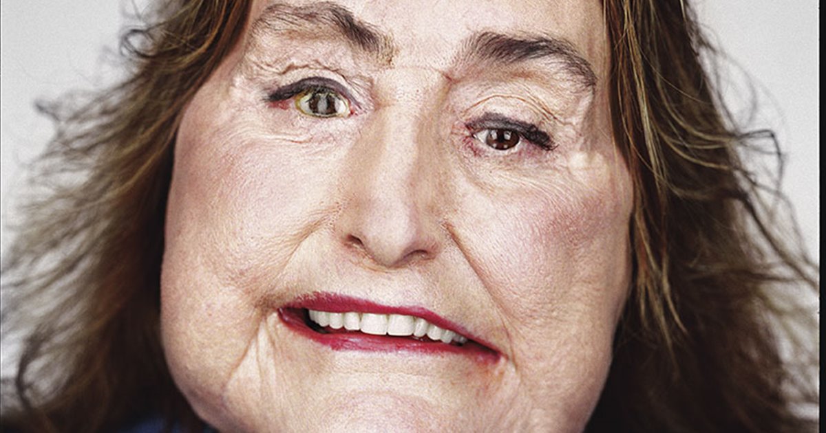 Connie Culp, el primer trasplante de cara de EEUU