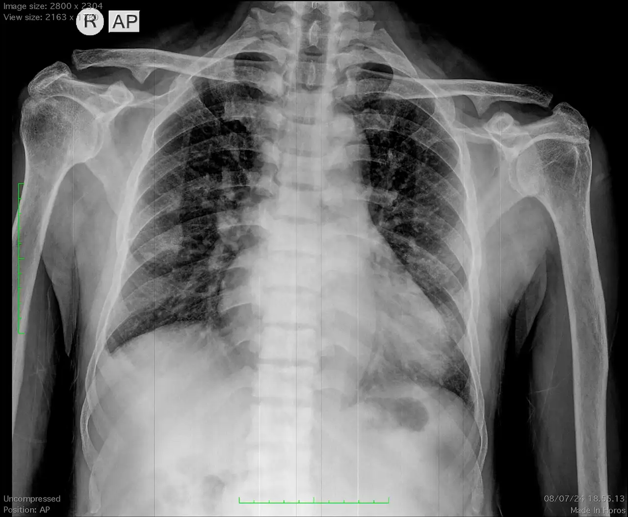 La salud del papa, en vilo: ¿qué es la neumonía bilateral y por qué es peligrosa?